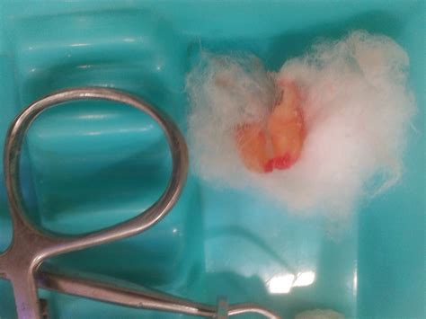 Ladivya Superspeciality Dental Clinic Distoangular Impacted Wisdom Tooth