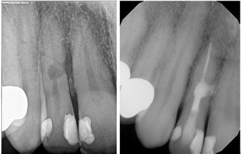 External Resorption Vs Internal Resorption