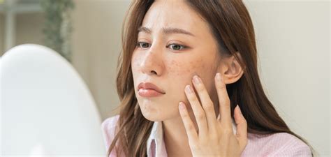 Is It Melasma Or Hyperpigmentation