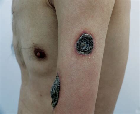 Malignant Syphilis Wpd