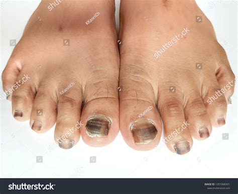 Why Do Your Nails Turn Black During Chemo At Robert Bence Blog