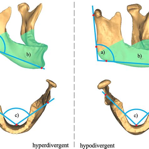 Characteristic Mandible Of A Hyperdivergent Patient Versus A
