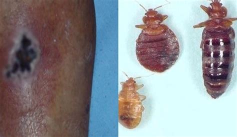 被臭虫咬后差点截肢 灭臭虫 清除臭虫