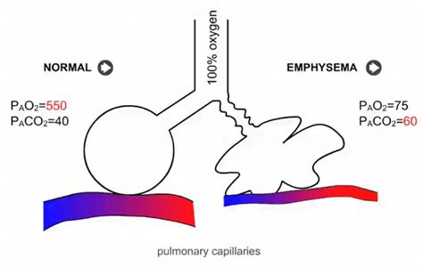 Hypercapnia Oxygen Induced Hypercapnia Depressed Hypoxic Drive