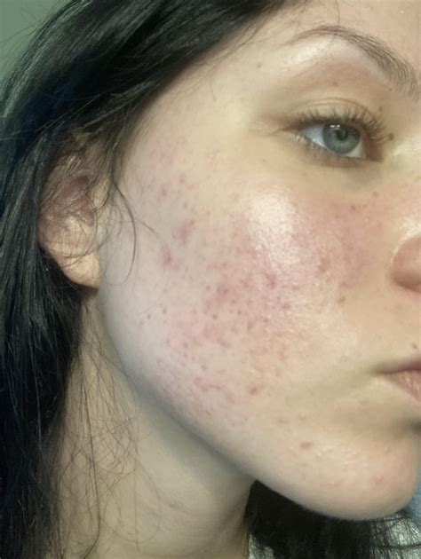 What Type Of Acnecondition Is This And How Do I Fix It More Info In