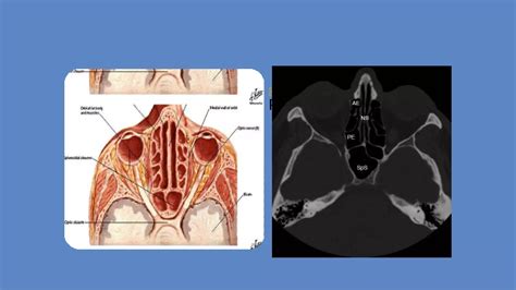 Ct Anatomy Of Paranasal Sinuses Pns Pkpdf Ppt Pdf Ct Anatomy Of Paranasal Sinuses Pns Pkpdf Ppt Pdf