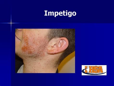 Common Skin Conditions In Wrestling Ringworm Impetigo Mulluscum