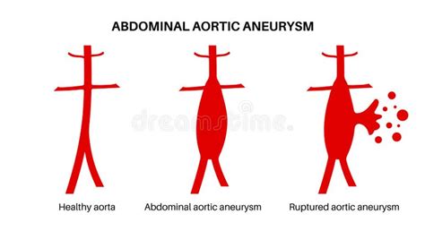 Abdominal Aortic Aneurysm Stock Vector Illustration Of Bulge 383808762