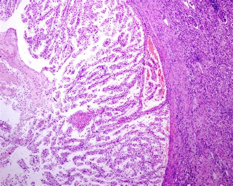 Renal Clear Cell Carcinoma Light Micrograph Stock Image C0613416