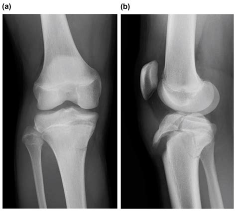 Type V Tibial Tubercle Avulsion Fracture With Suspected Complication Of