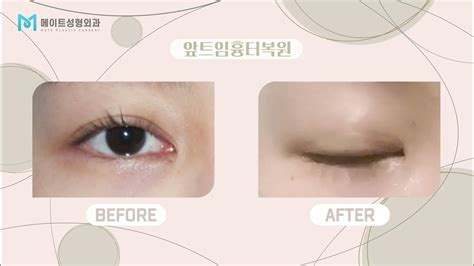 이상하고 어색한 앞트임 흉터 자연스럽고 둥근 뾰족 모양으로 개선 Youtube