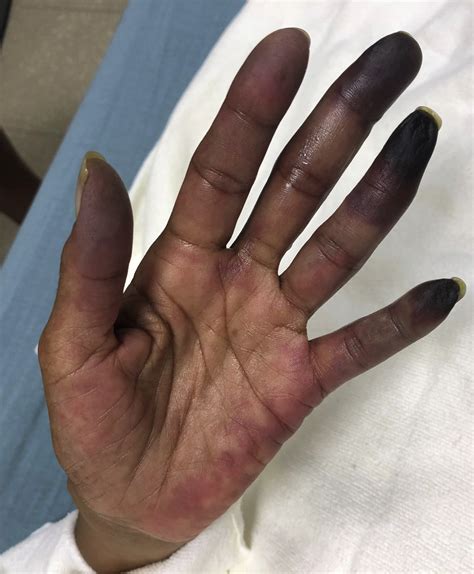 Woman With Discolored Fingers Annals Of Emergency Medicine