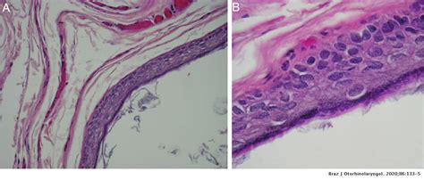 Epidermoid Cyst Of The Suprasternal Region A Rare Case Report