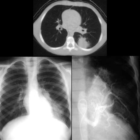 Pulmonary Sequestration Pediatric Radiology Reference Article Pediatric Imaging Pedsimaging
