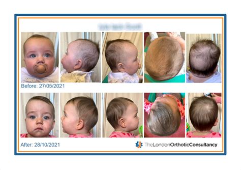 Iylas Plagiocephaly Treatment