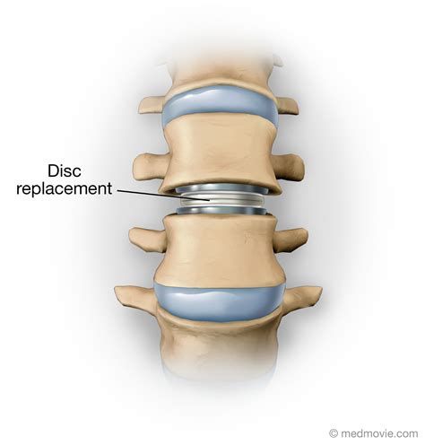 Artificial Cervical Disc Types