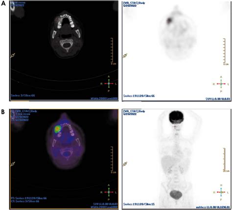Importance Of 3 Dimensional Imaging In The Early Diagnosis Of