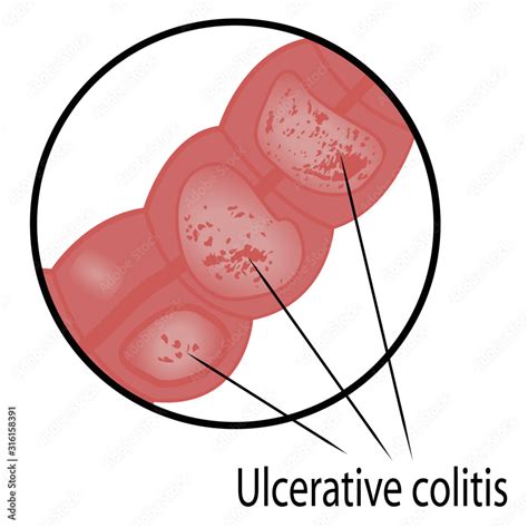 Ulcerative Colitis Intestine Disease Vector Graphic Illustration For