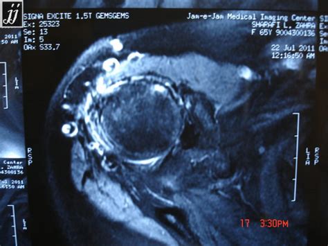 Msk Shoulder Joint Osteoarthritis Dislocation And Deformity 2 Radioogle