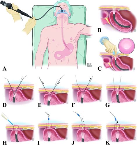 Novel Modified Seldinger Technique For Gastrojejunal Feeding Tube