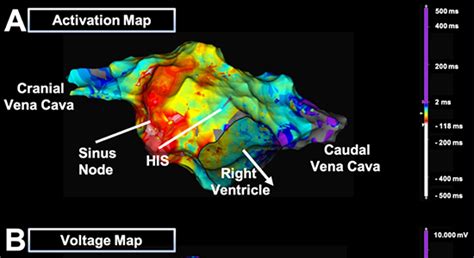 3d Endocardial Mapping University Of Copenhagen