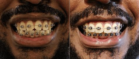 Dear People Who Had Have Bite Blocks On Your Teeth How Do You Eat R Braces