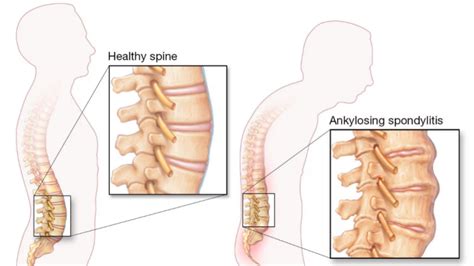 Ankylosing Spondylitis And Hla B27 Detection