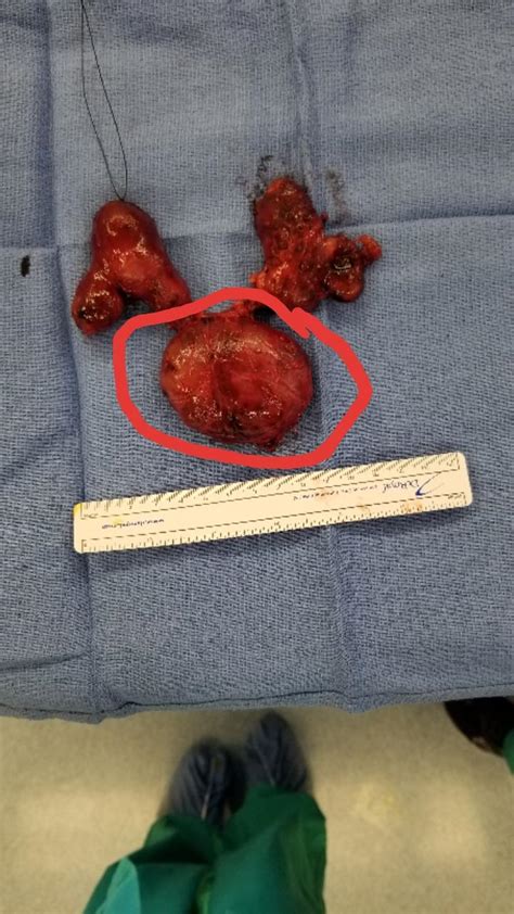 I Had My Thyroid Removed On Friday This Is What An Enlarged And Very Multinodular Thyroid Looks