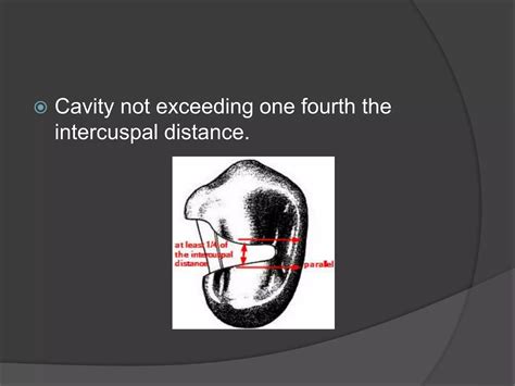 Modifications Of Class 2 Cavity Preparations Pptx