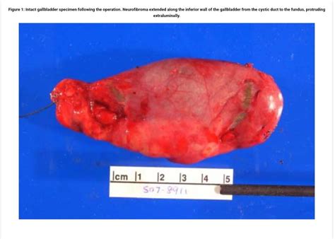 Several Gallbladder Inflammation Normal Gallbladder At The End For Reference Rsurgery