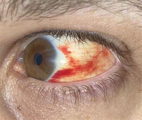 What Is Subconjunctival Hemorrhage Klarity Health Library