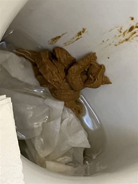 Is This Fatty Stool Rpoop