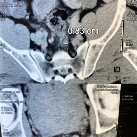 Classification Of Prostate Cancer A Gleason Grading System B Download Scientific