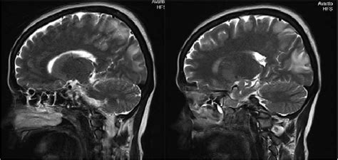 Sagittal View Of Mri Brain Showing Bilateral Occipital Parietal