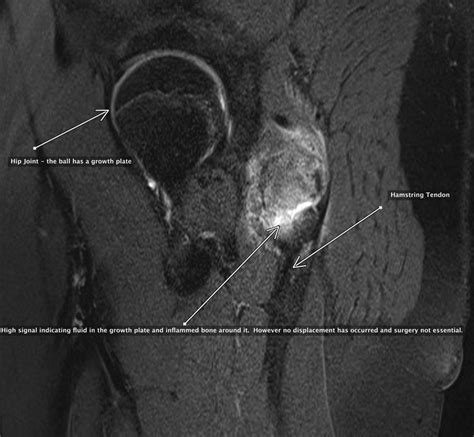 Traction Apophysitis Of Ischium Ballaratosm Ballarat Orthopaedics