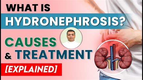 What Is Hydro Nephrosis Causes And Treatment Explained Youtube