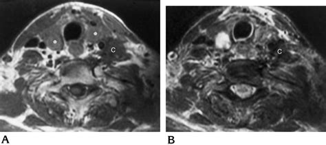 Nonspecific Thyroid Masses Not Reported On First Reading A