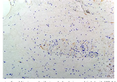 Figure 5 From Degos Disease Malignant Atrophic Papulosis Semantic