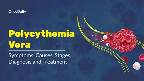 Polycythemia Vera Symptoms Causes Stages Diagnosis And Treatment