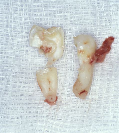 Ectopic Displaced Teeth