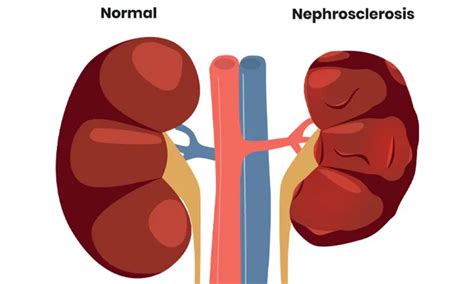 Creatinine Level Clearance Test