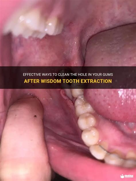 Effective Ways To Clean The Hole In Your Gums After Wisdom Tooth Extraction Medshun