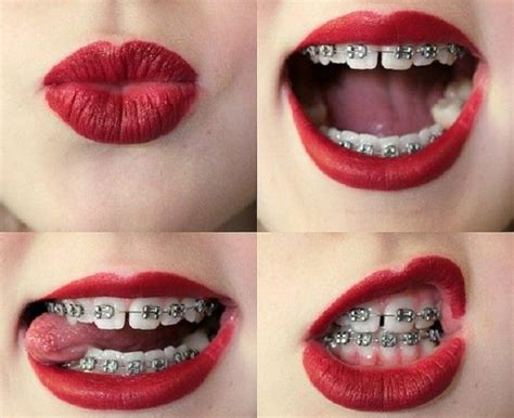 Enjoy Your Braces Journey Watch Your Smile Go From Ordinary To