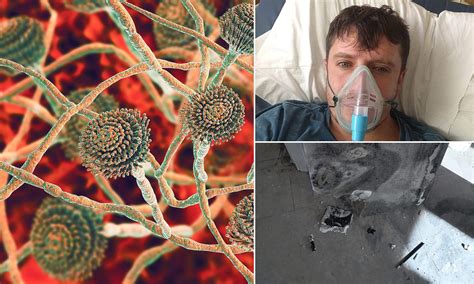 Lethal Super Fungus That Expert Predicts Could Kill Nine Million In