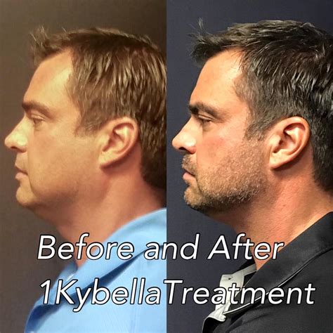 Kybella Injections Sculpt Double Chin Away