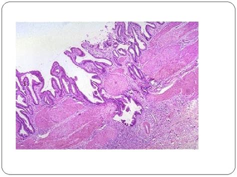 Pathology And Pathogenesis Of Cholecystitis Pathology And Pathogegenesis