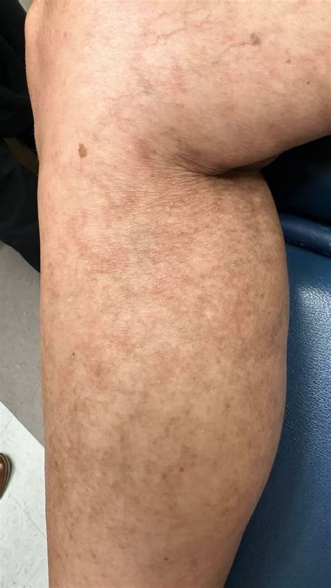 Lupus Vasculitis Causes Symptoms And Diagnosis