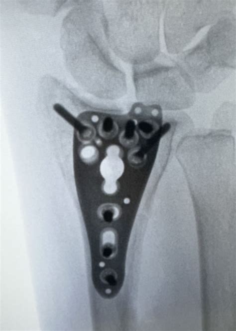 Variax 2 Distal Radius Locking Plate System Implants Orthobullets