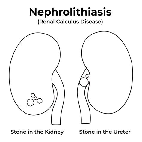 Nephrolithiasis Renal Calculus Disease Science Design Illustration Diagram 48042323 Vector Art