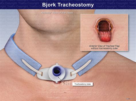 Bjork Tracheostomy